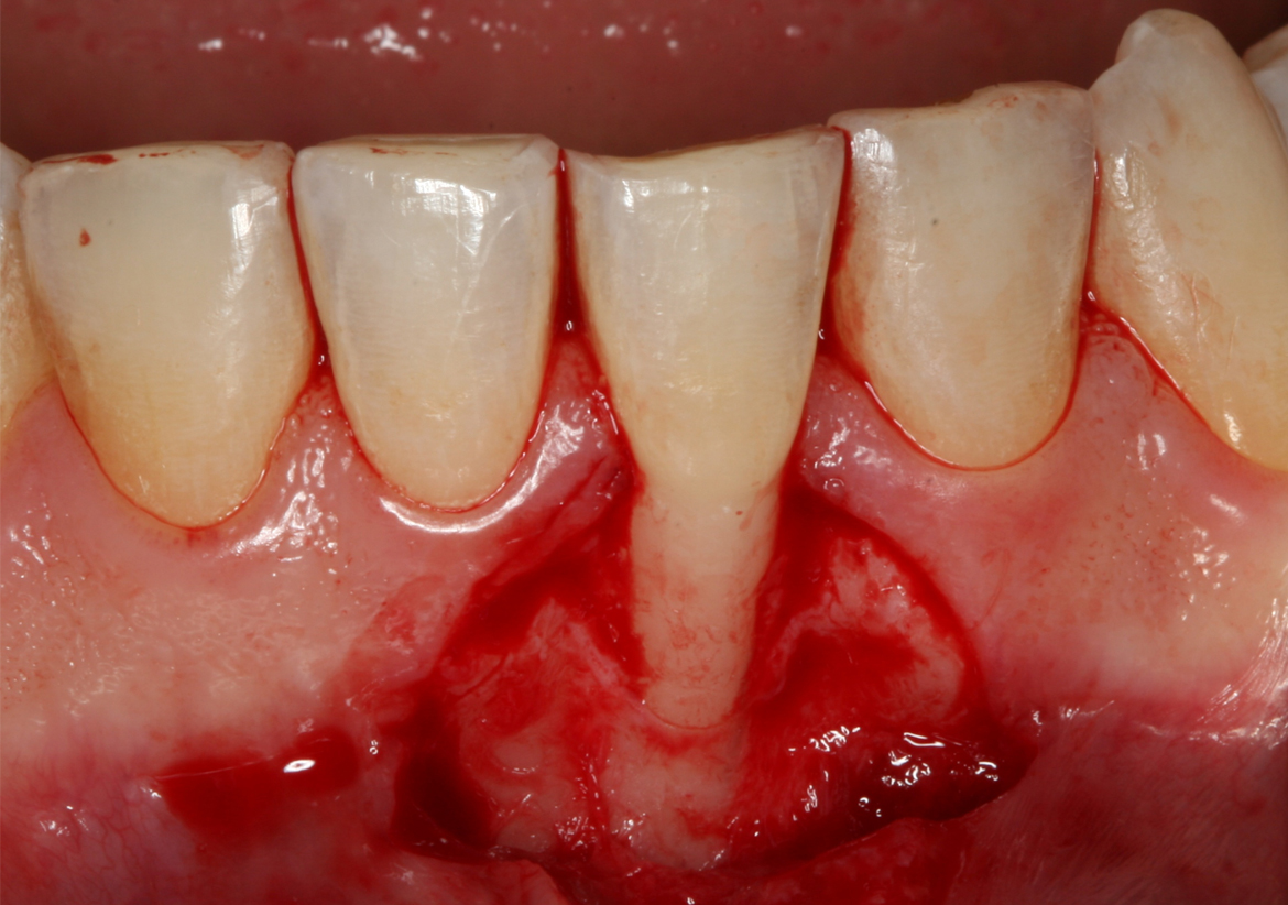 Mandibular Anterior Teeth