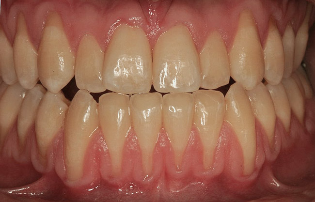 A Simple Approach to the Connective Tissue Graft (#258) | Dentistry ...